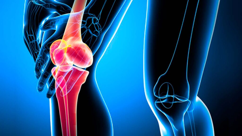 Diz Eklemi Kireçlenmesi Nedir? • Op. Dr. Seçkin Basılgan