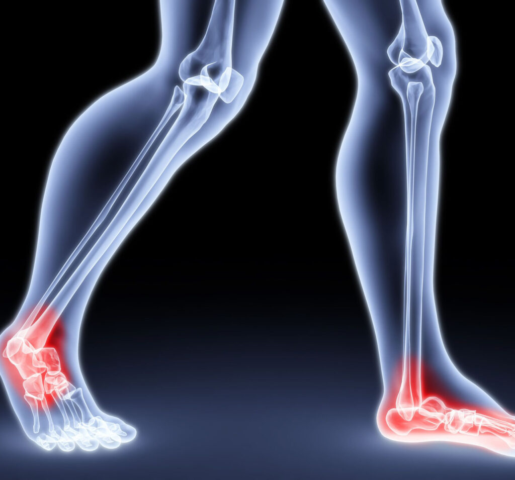 Stres Kırığı Nedir? • Op. Dr. Seçkin Basılgan